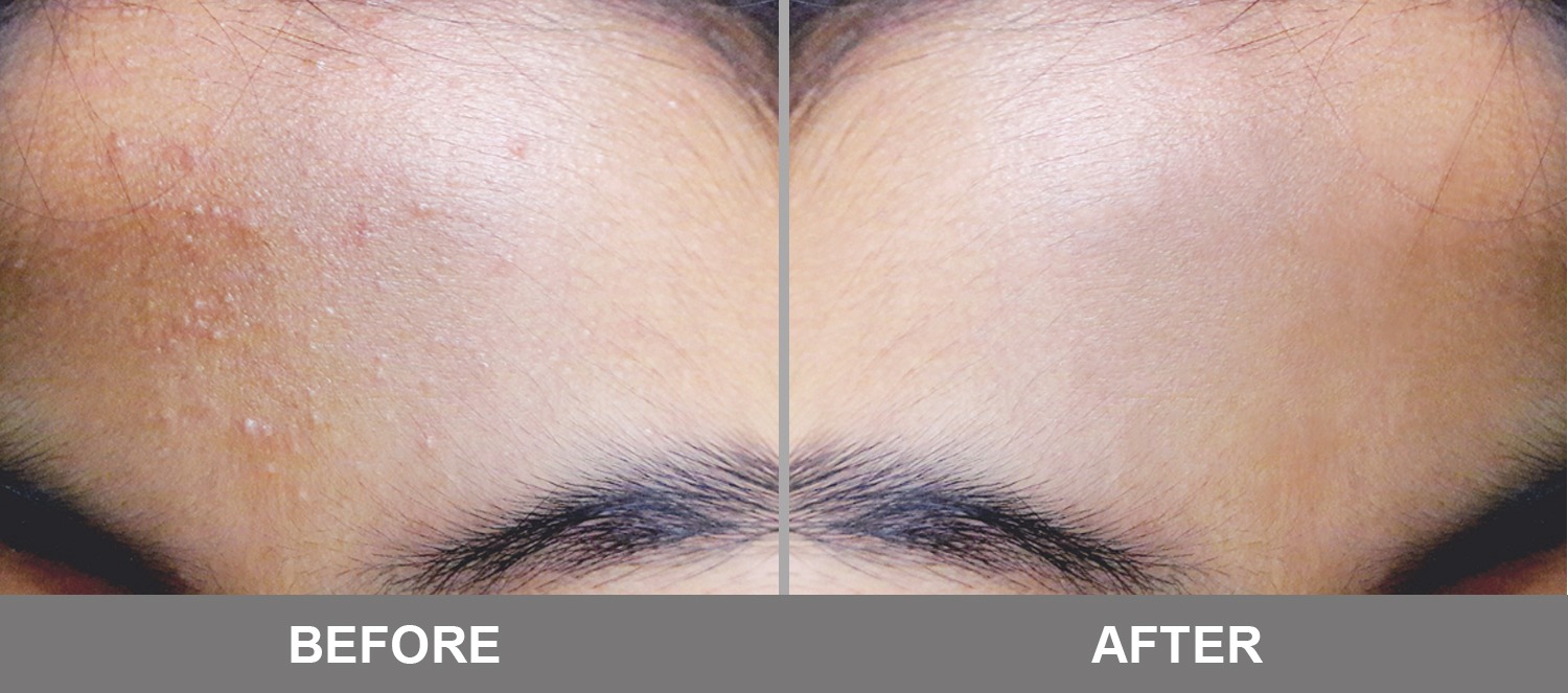 Buy Suthol Liquid & Gel Online - Stop summer Skin Irritations